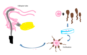 Zygote Intrafallopian Transfer (ZIFT) - SpOvum® Blog